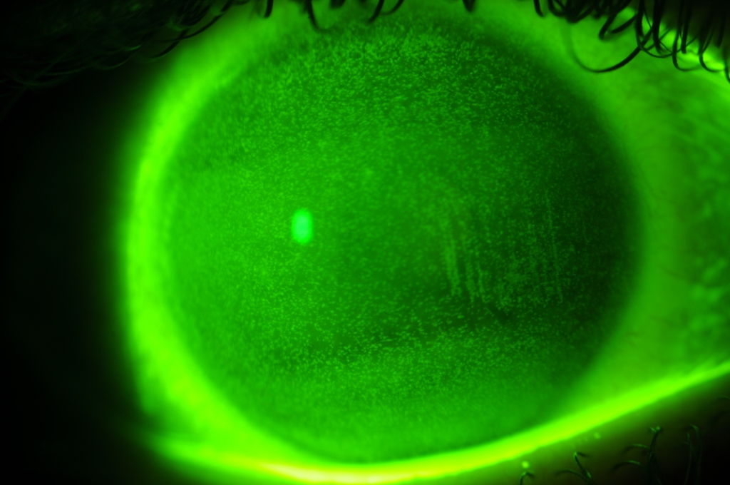 Matching lens care systems with patients | Contact Lens Update