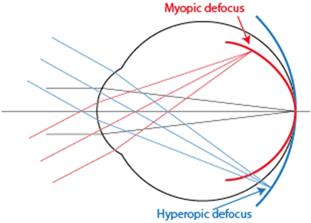 Use of contact lenses in myopia control: A case study | Contact Lens Update