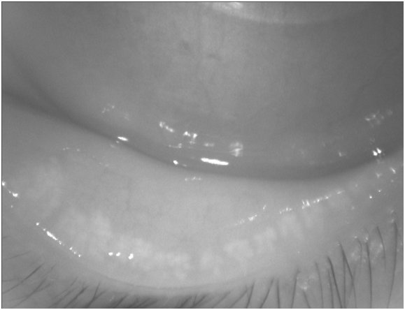 Contact lens wear and meibomian gland dysfunction | Contact Lens Update