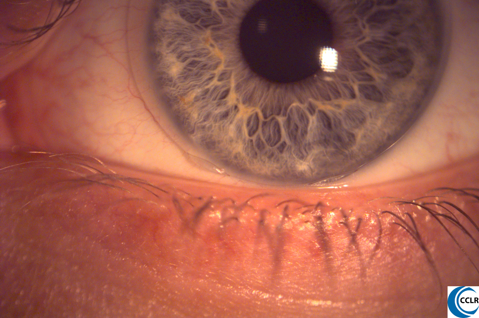 Edge lift | Contact Lens Update