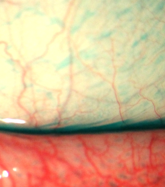 Lid wiper epitheliopathy and dry eye symptoms in contact lens wearers ...