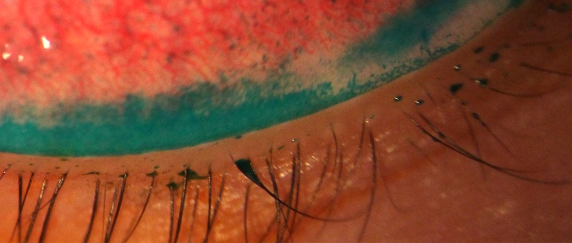 The evaluation of lid wiper epitheliopathy in contact lens wearers in a ...