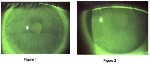 What do we know about solution-induced corneal staining? | Contact Lens ...