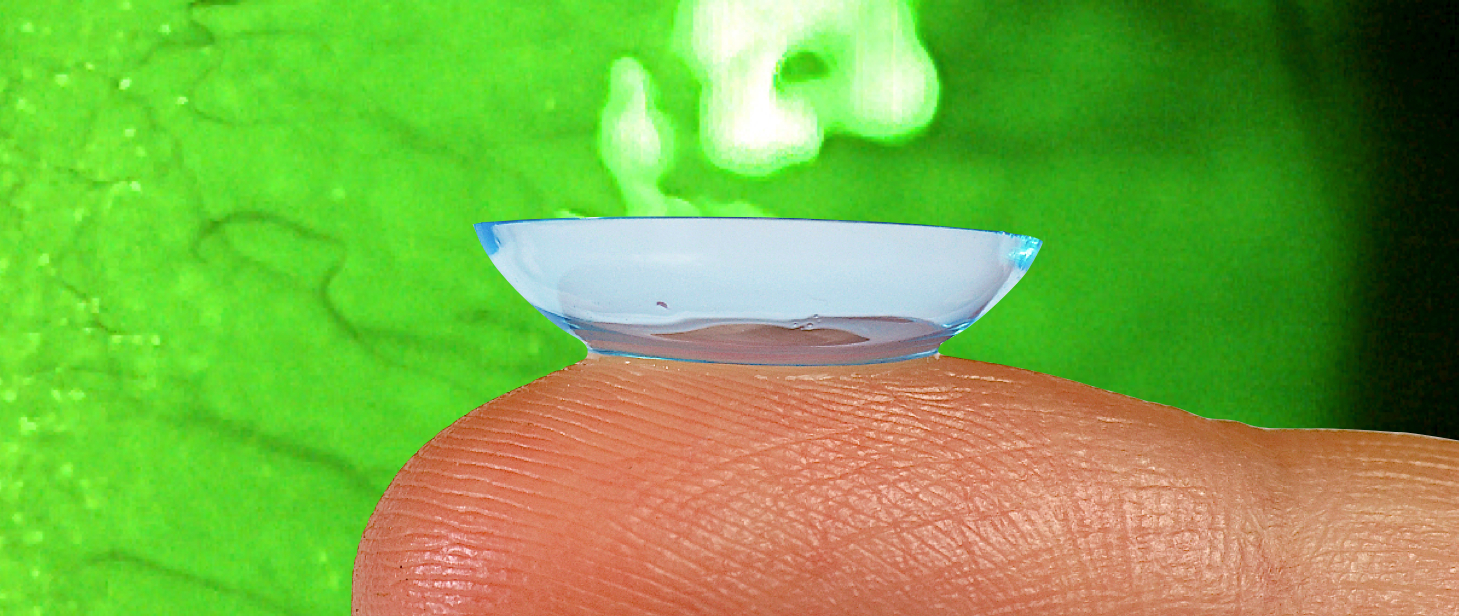 Solution-Induced Corneal Staining (SICS): Symptoms and Staining ...