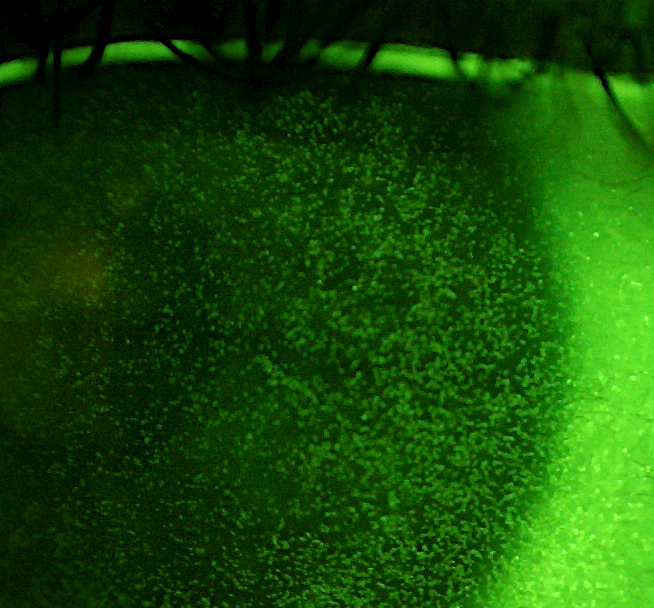 Solution-induced corneal staining: Insights from the laboratory ...