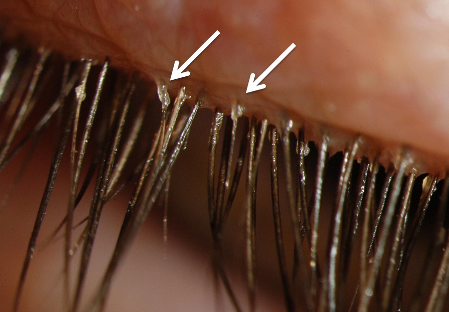 Everything you wanted to know and were afraid to ask about Demodex ...