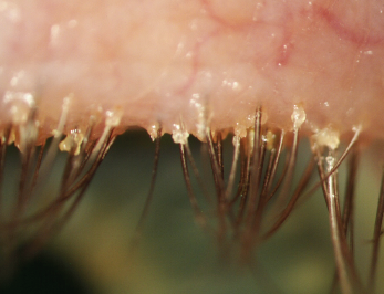 Managing Demodex in clinical practice | Contact Lens Update