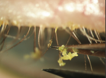 Managing Demodex in clinical practice | Contact Lens Update