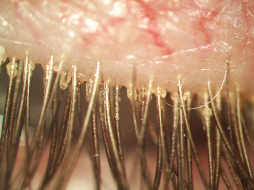 Managing Demodex in clinical practice | Contact Lens Update