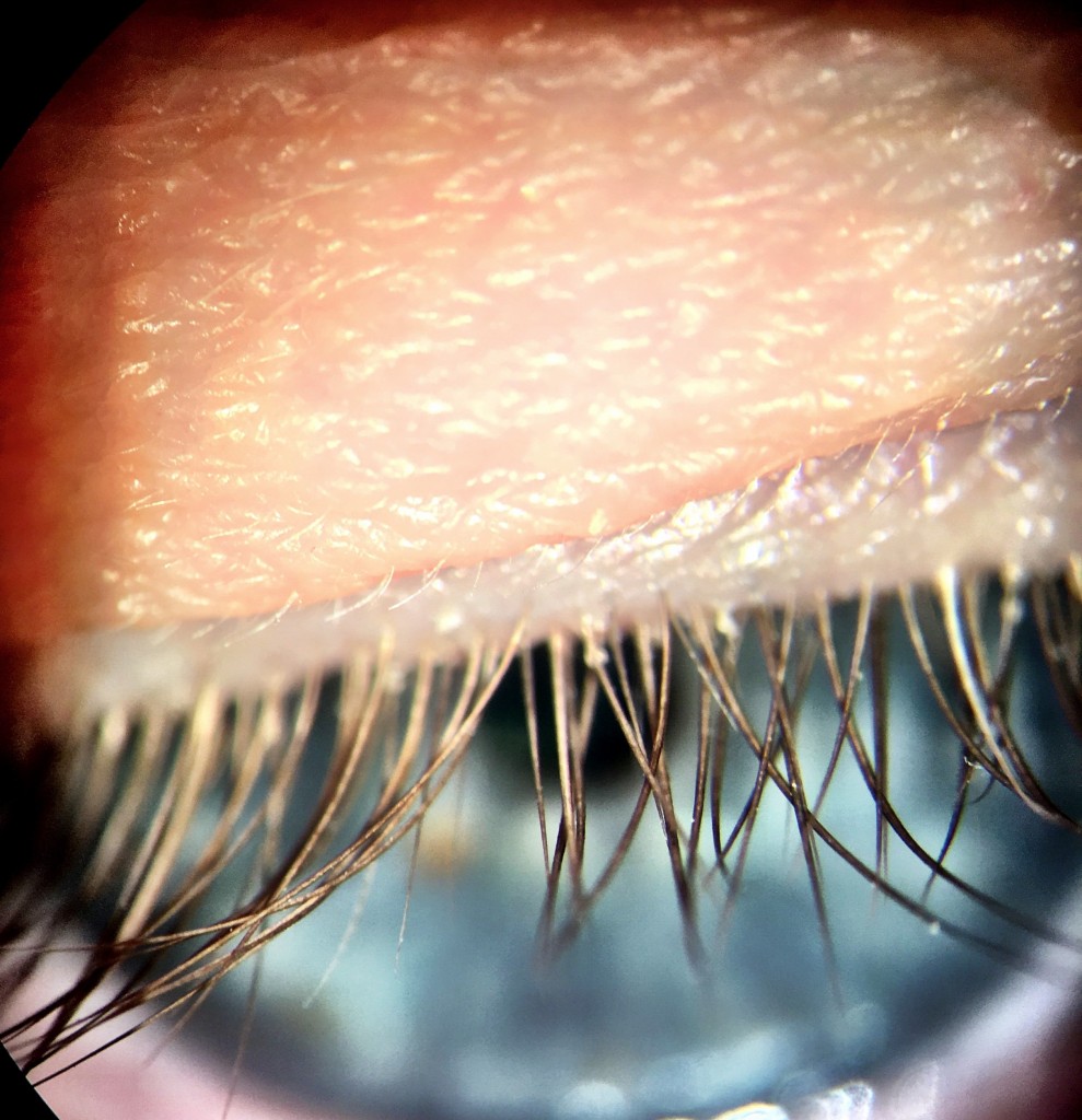 Keeping a lid on dropout: a view from practice | Contact Lens Update