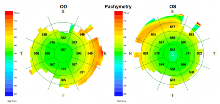 Three Case Series Report: The use of Axial Length in Myopia Management ...