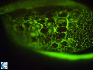 Non-Compliance With Contact Lens Replacement Schedules: Does it really ...