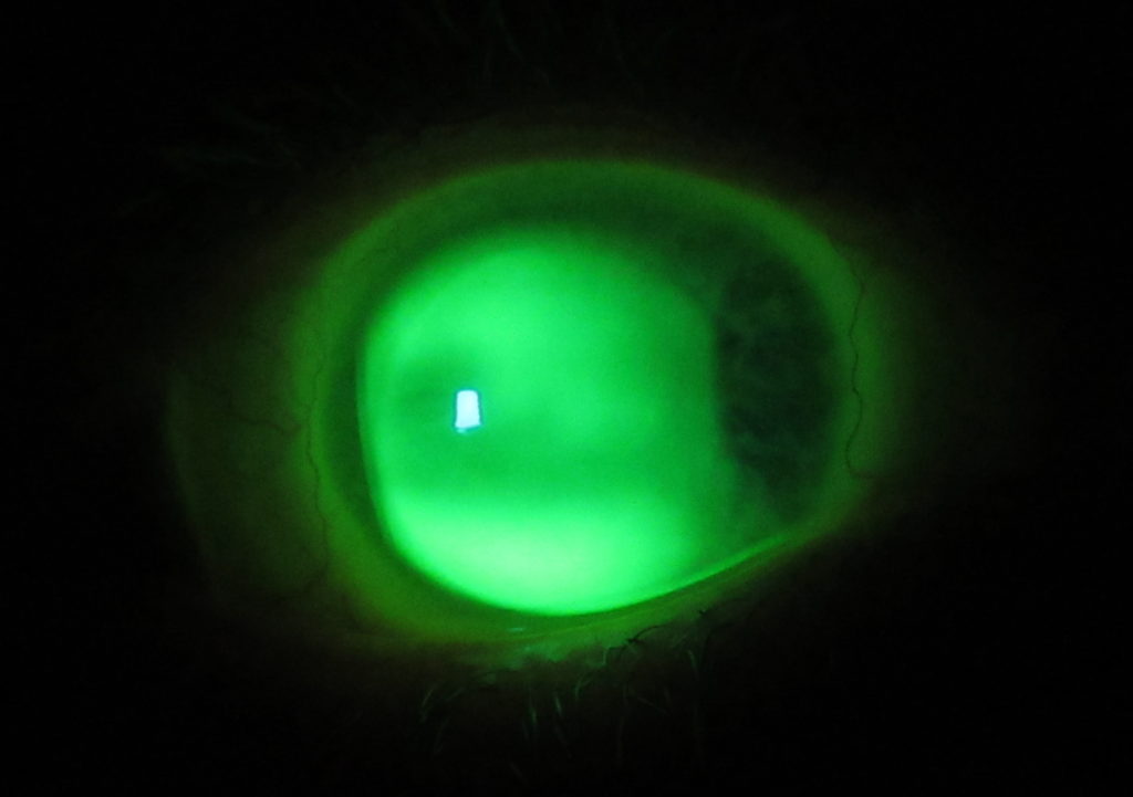 Troubleshooting scleral lens cases for improved performance | Contact ...