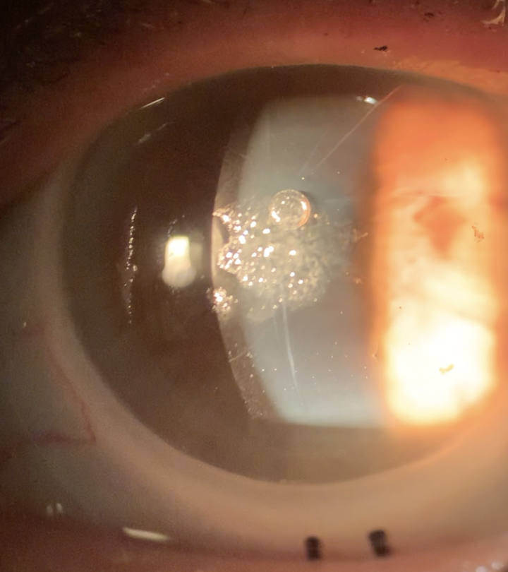 Troubleshooting scleral lens cases for improved performance | Contact ...