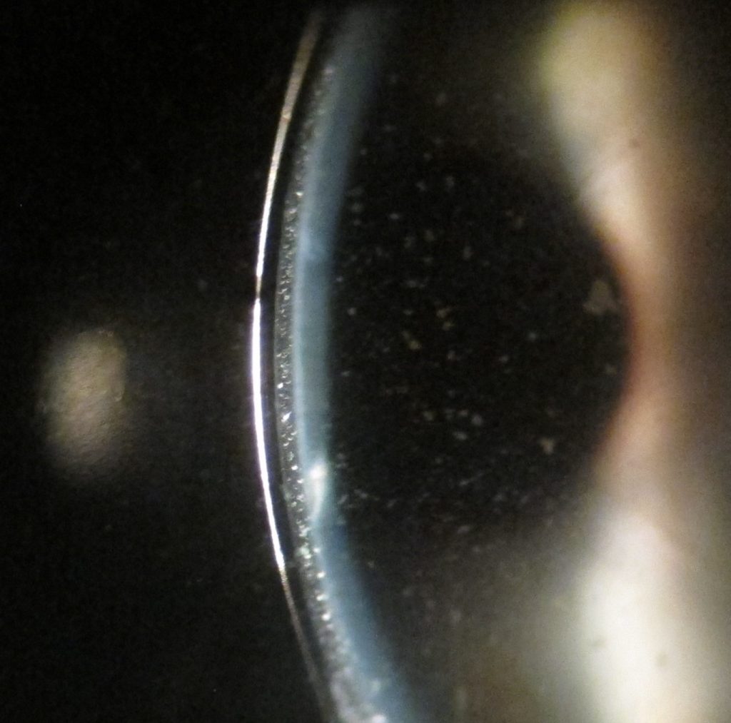 Troubleshooting scleral lens cases for improved performance | Contact ...