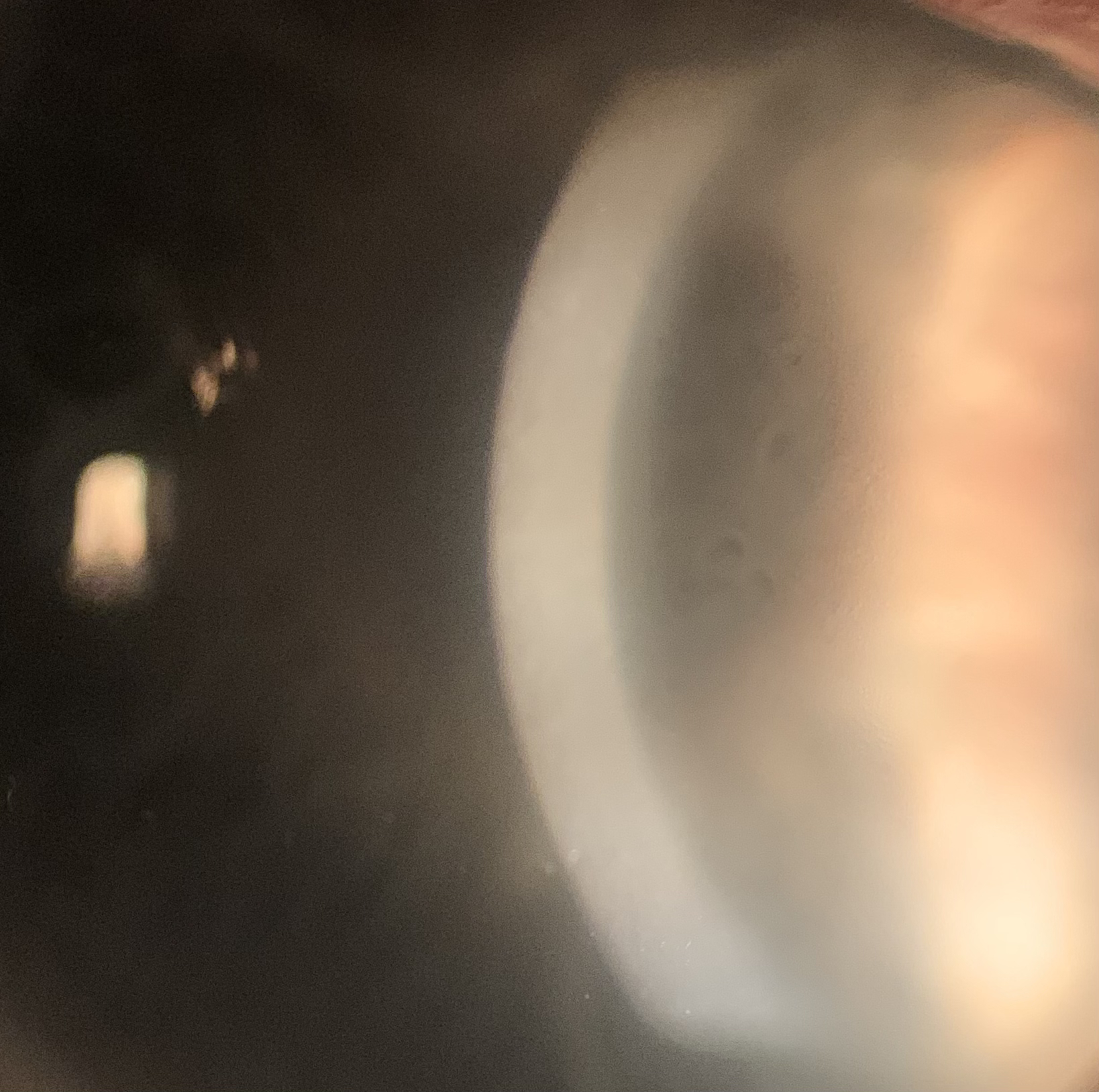 Troubleshooting scleral lens cases for improved performance | Contact ...