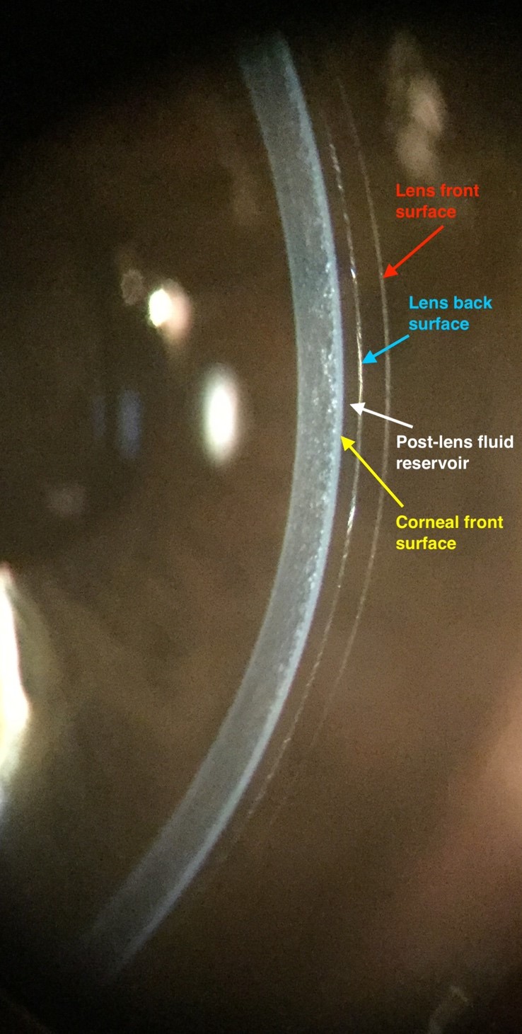 Article Review: How Can We Best Measure the Performance of Scleral ...