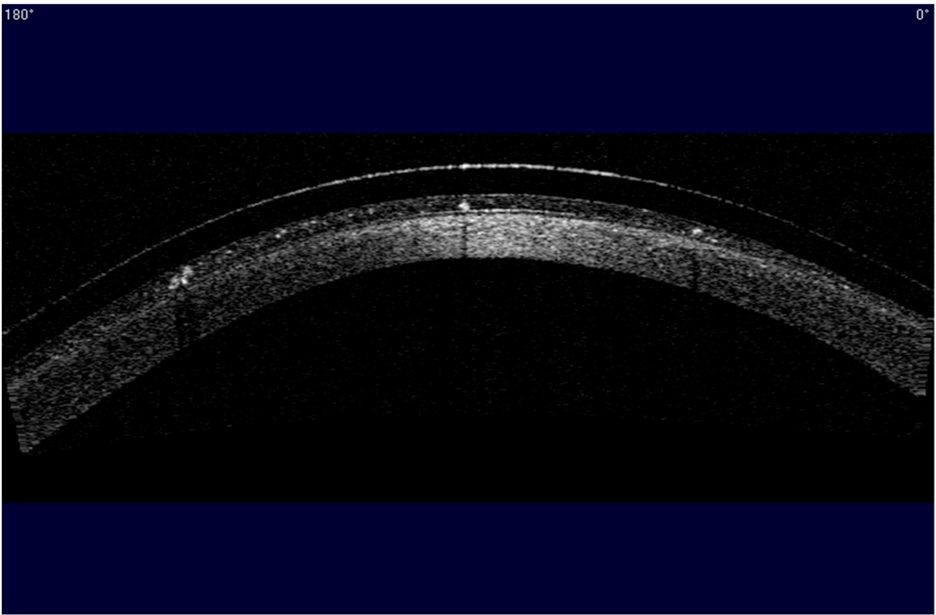 Article Review: How Can We Best Measure the Performance of Scleral ...