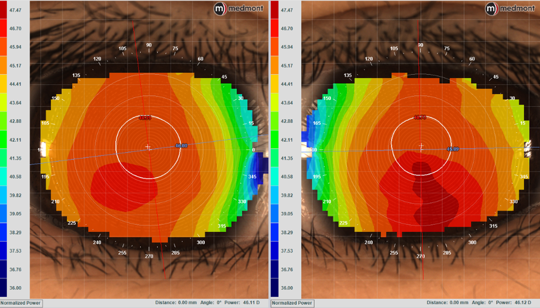 Case Report: How Often Should Orthokeratology Lenses for Myopia Control ...