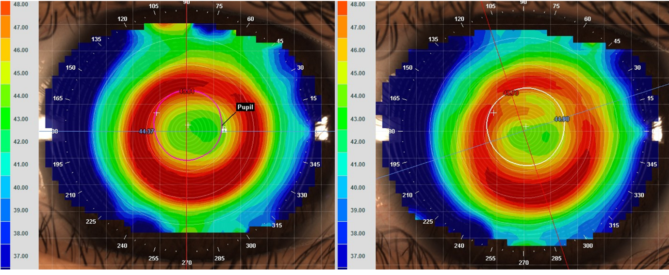 Case Report: How Often Should Orthokeratology Lenses for Myopia Control ...