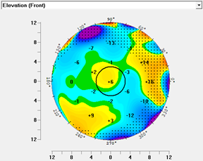 Orthokeratology Design Considerations for Hyperopia with Presbyopia ...