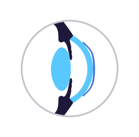 Ortho-k for Refractive Error Correction | Contact Lens Update